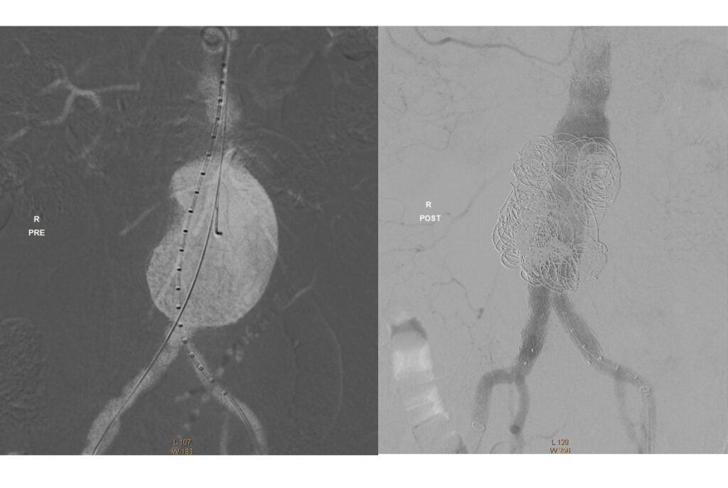 Aortic Aneurysm Treatment in Singapore