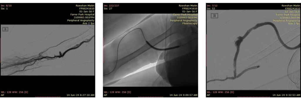 Dialysis Procedure in Singapore | Types of Dialysis Access Options